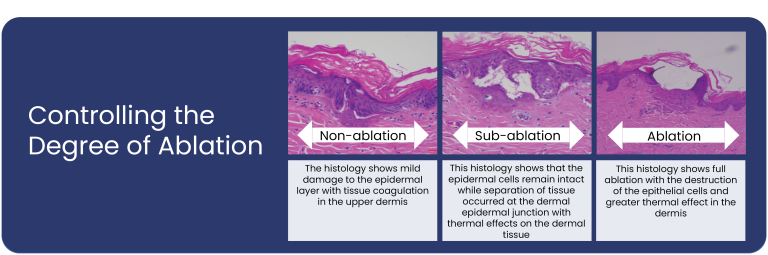 NOUVADerm™ Advanced Laser Skin Resurfacing For All Skin Types