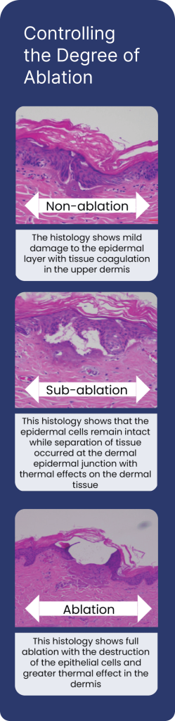 NOUVADerm™ Advanced Laser Skin Resurfacing For All Skin Types