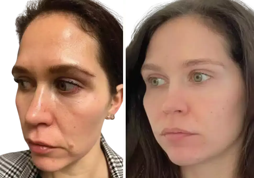 Cellenis® Derma PRP - A Natural Way To Fortify Skin